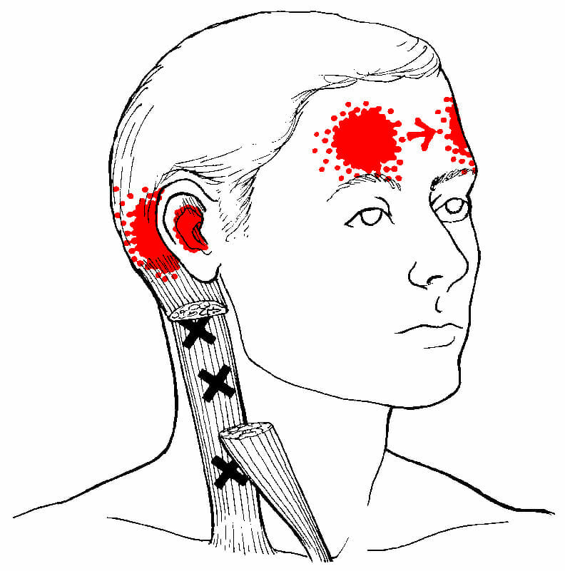 Relieve Your Headache with Self Massage for SCM Trigger Points ...