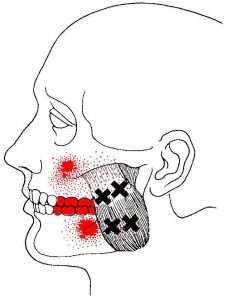 TMJ Self Massage The Masseter | Restorative Health and Wellness